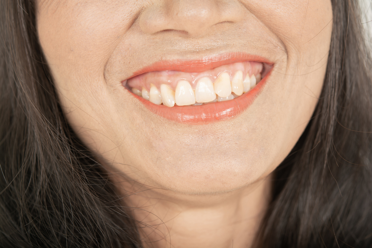 Crooked and Crowded Teeth - Newbury Park Dentist