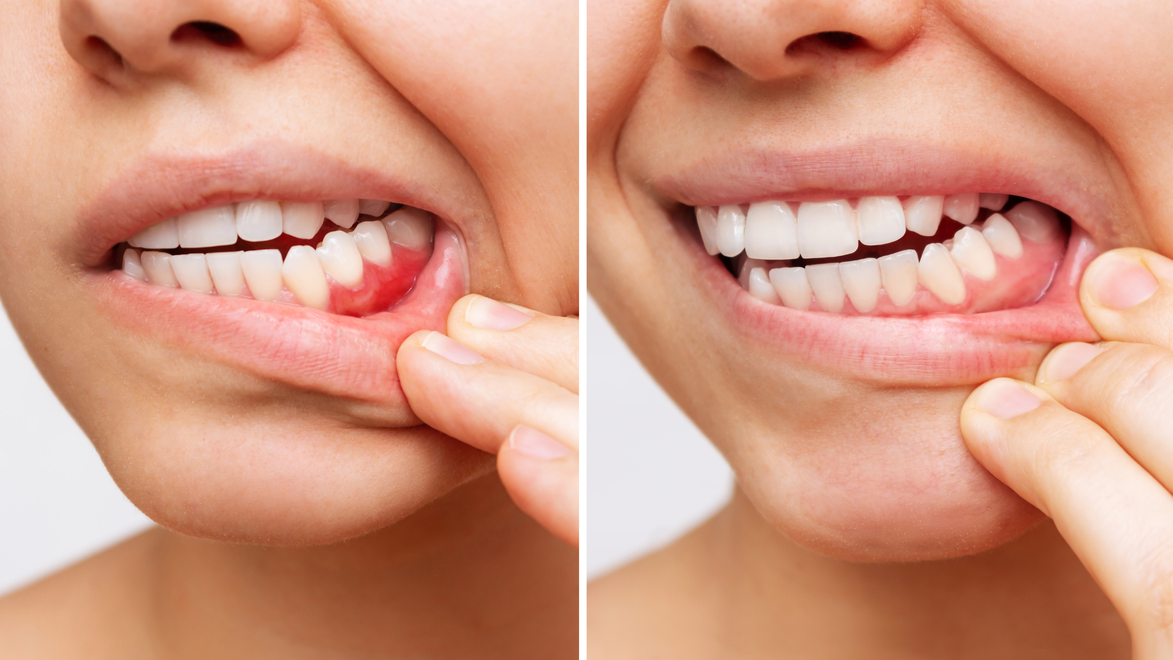Very Red Gums, Causes, Symptoms - Newbury Park Dentist